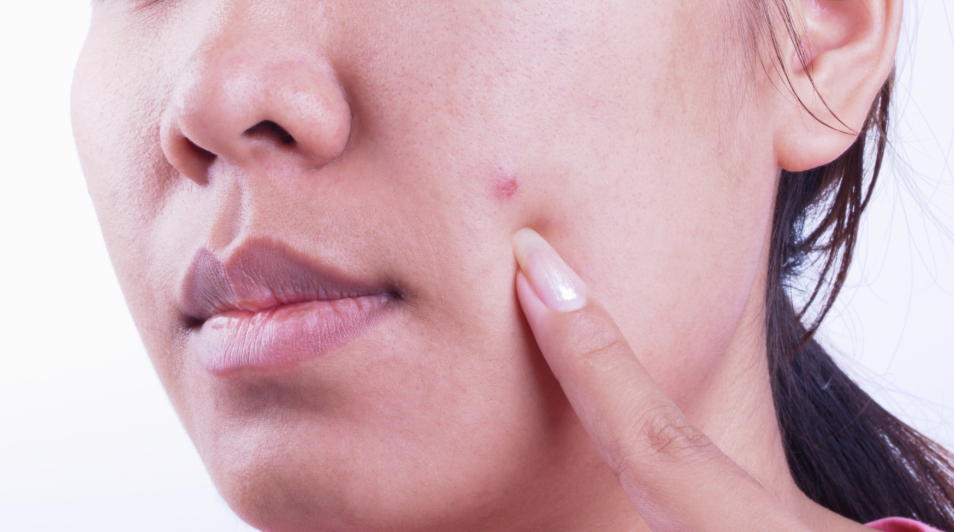 Can Skin Cancer Look Like A Pimple Can Skin Cancer Look Like A Pimple